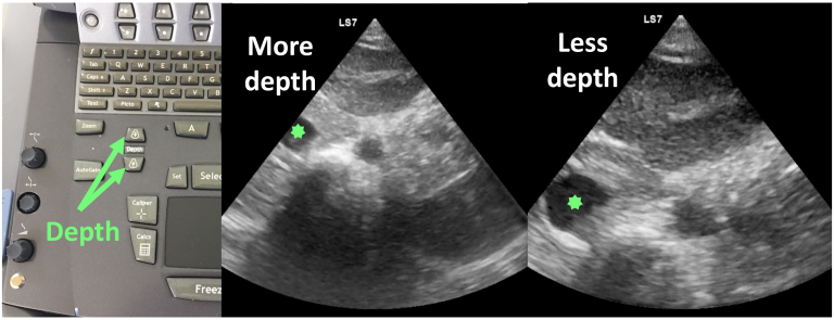 Understanding ultrasound images | kidSONO