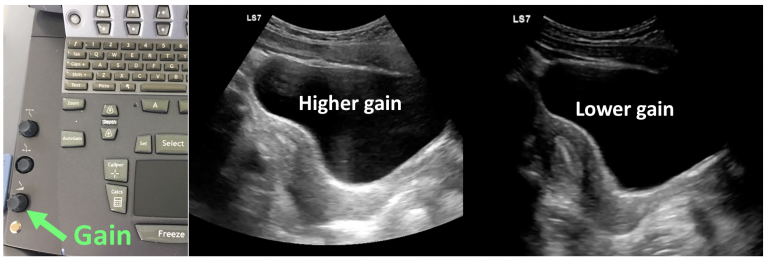 Understanding ultrasound images | kidSONO