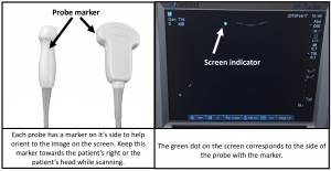 Understanding ultrasound probes | kidSONO