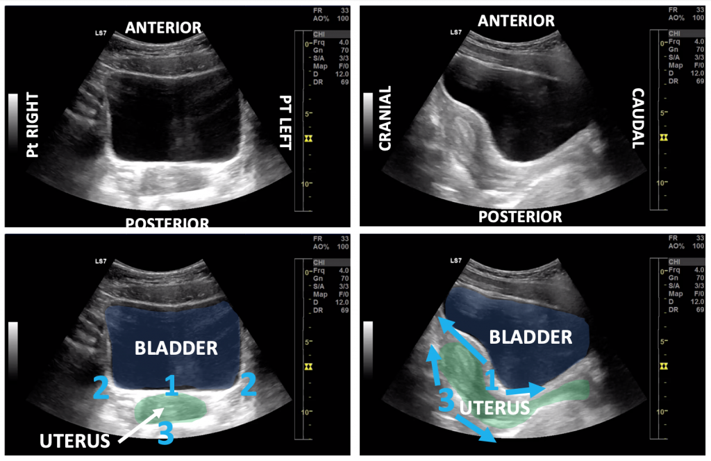 Suprapubic | kidSONO
