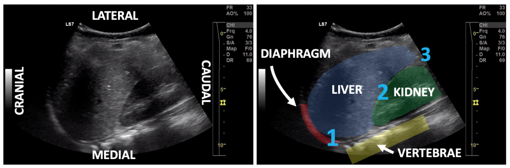 Right upper quadrant | kidSONO