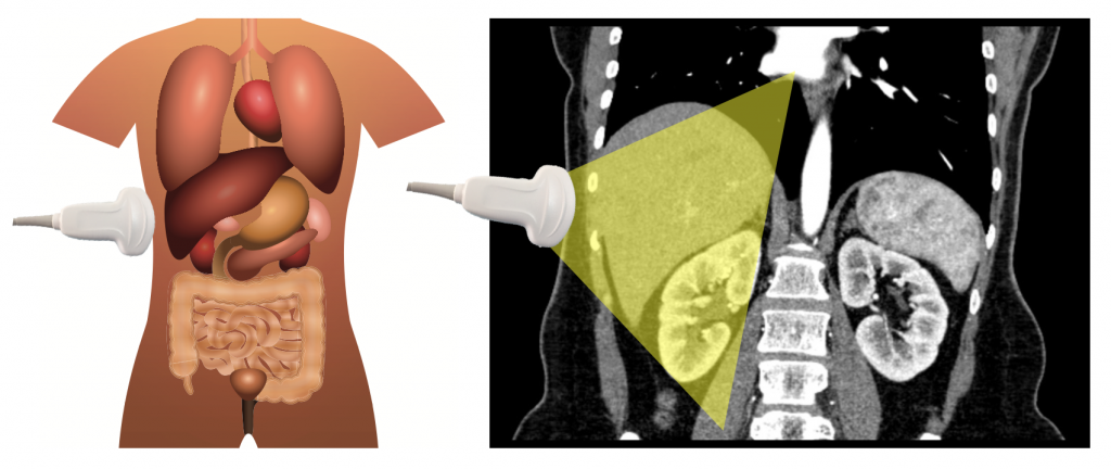 Right upper quadrant | kidSONO