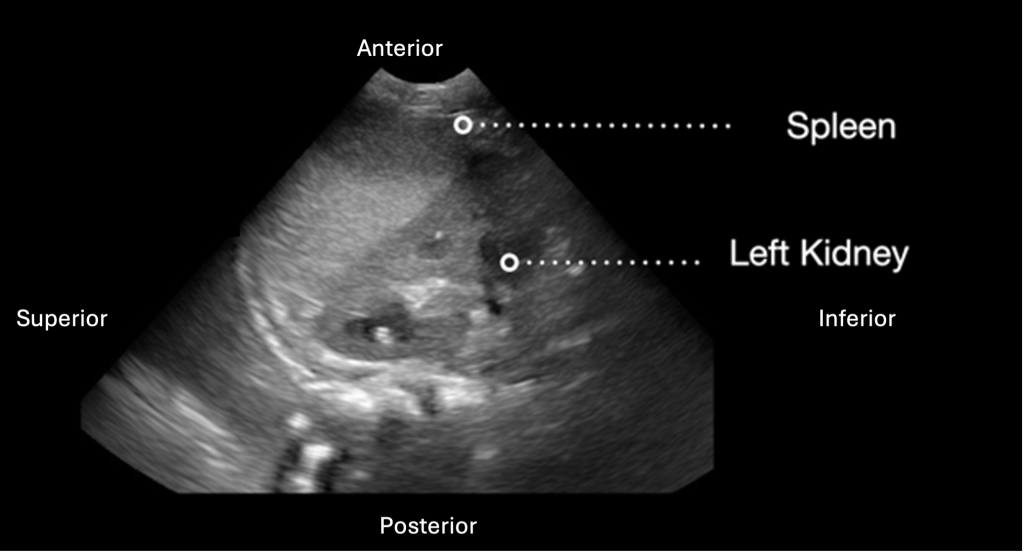 Left Kidney | kidSONO