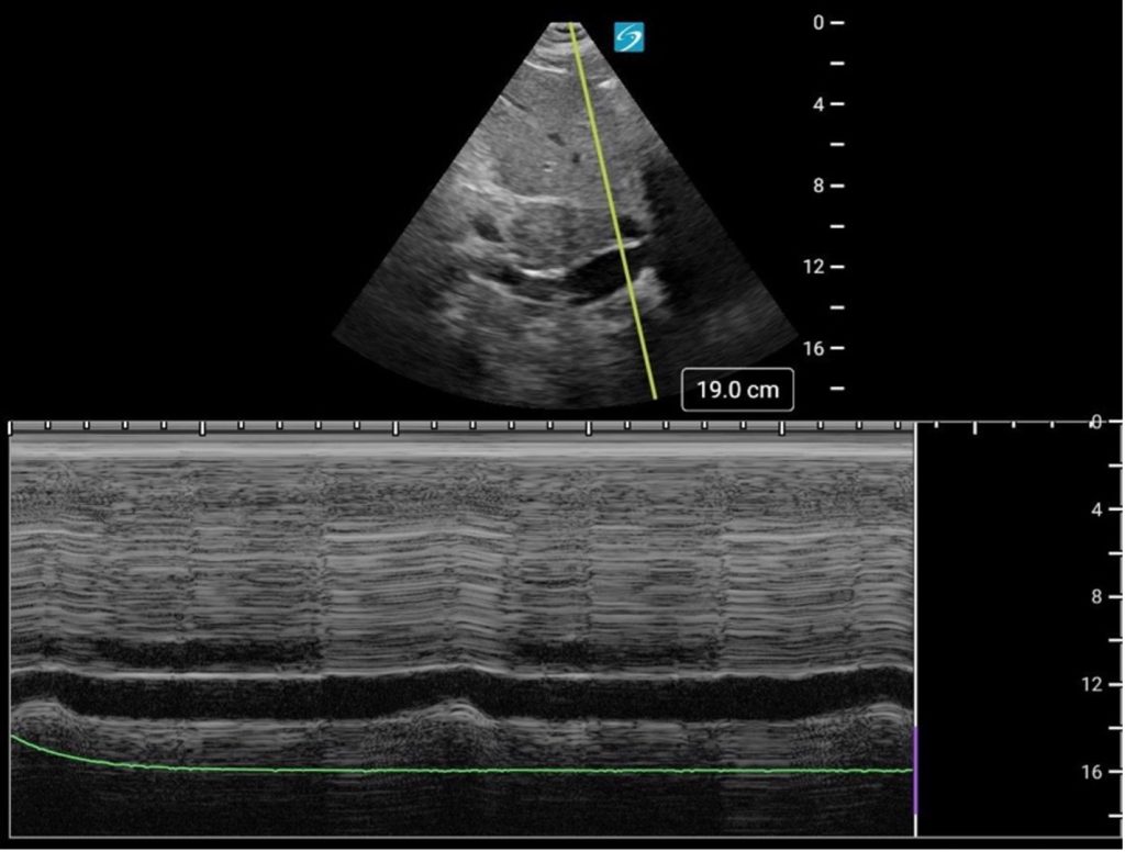 Subxiphoid IVC | kidSONO